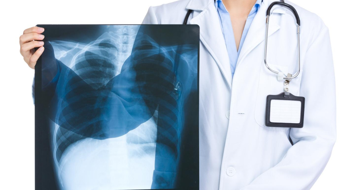 El 40 % de pacientes con cáncer de pulmón avanzado no presenta síntomas