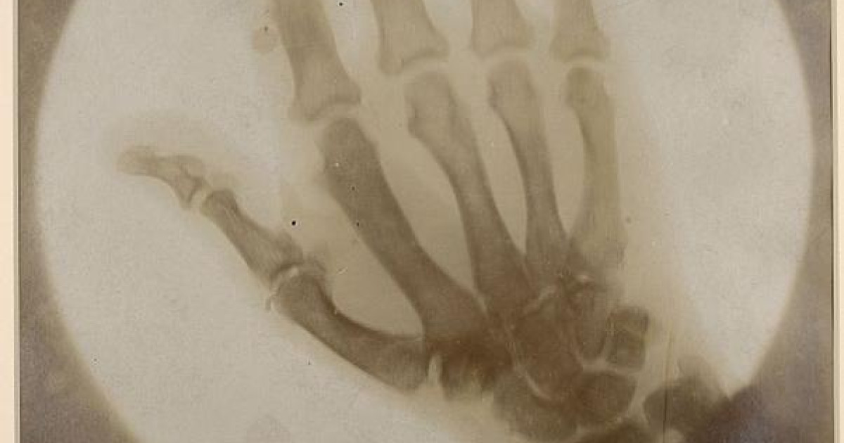 Qué es la acromegalia, la enfermedad rara que suele debutar entre los ...