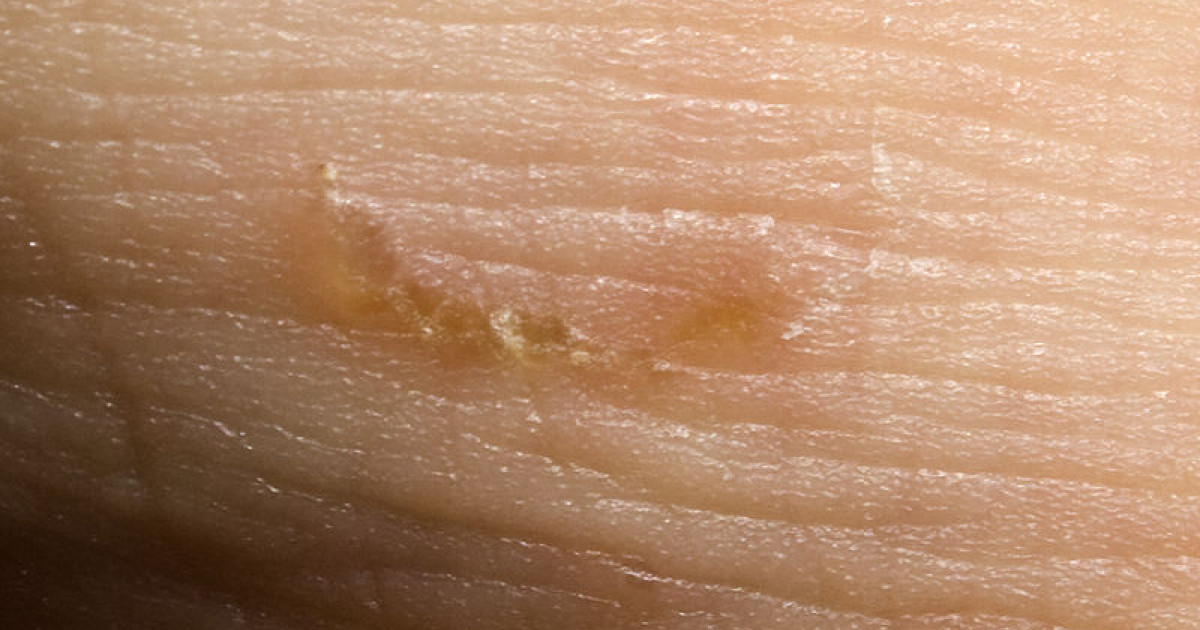 Aumentan los casos de sarna en España: ¿cuáles son sus causas? ¿Cómo se trata?