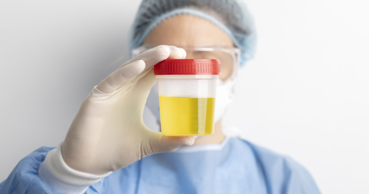 Los médicos revelan qué significa cuando tu orina se vuelve marrón ...