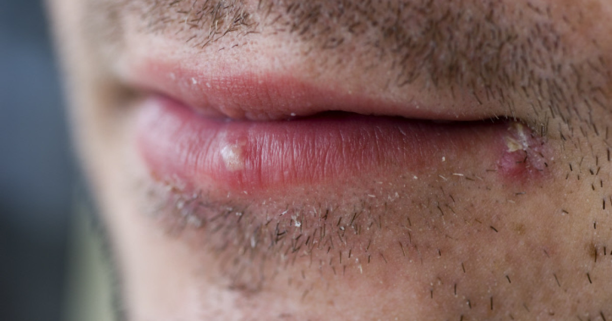 Se Puede Evitar Que Se Desarrolle Un Herpes Labial